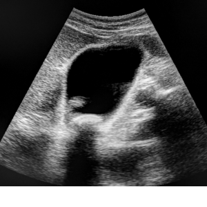 Gallensteine – Mack Prävention